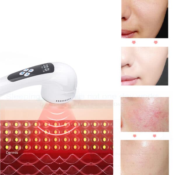 JBA-SBH LLLT LED FACIAL HANDHELD DEVICE FOR ACNE – JBA